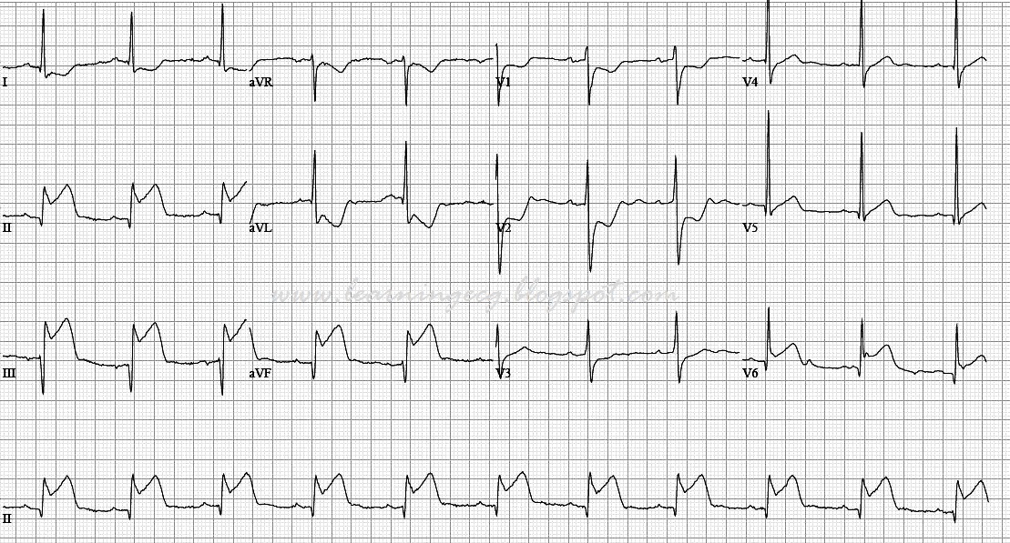 ECG Rhythms: Inferior wall STEMI with lesion in the left circumflex ...
