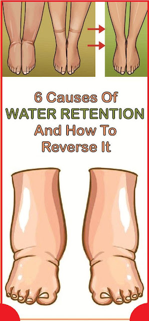 6 Causes of Water Retention and How to Reverse It | Wellness Days