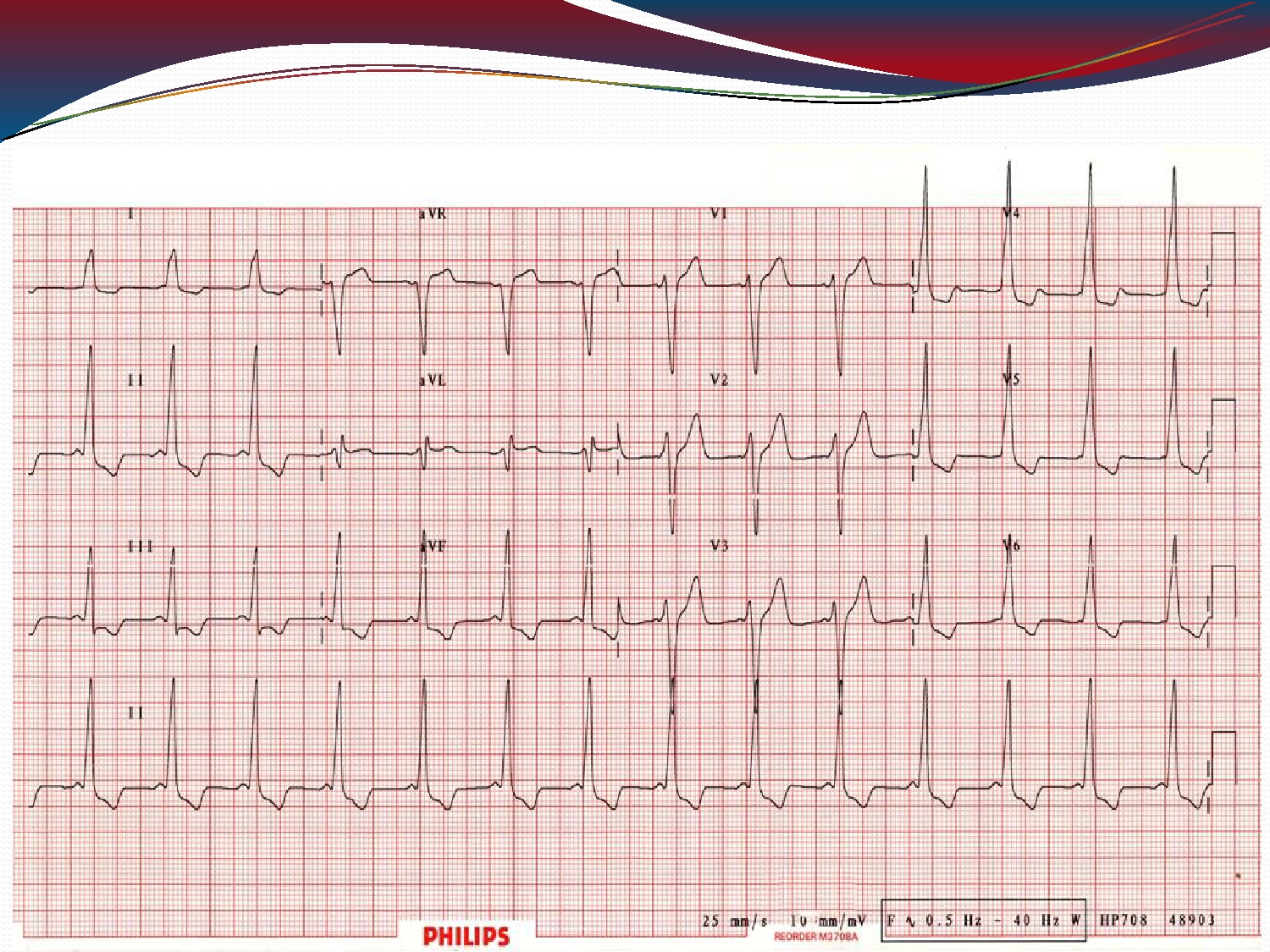 TEMAS MÉDICOS: ELECTROCARDIOGRAMA NORMAL