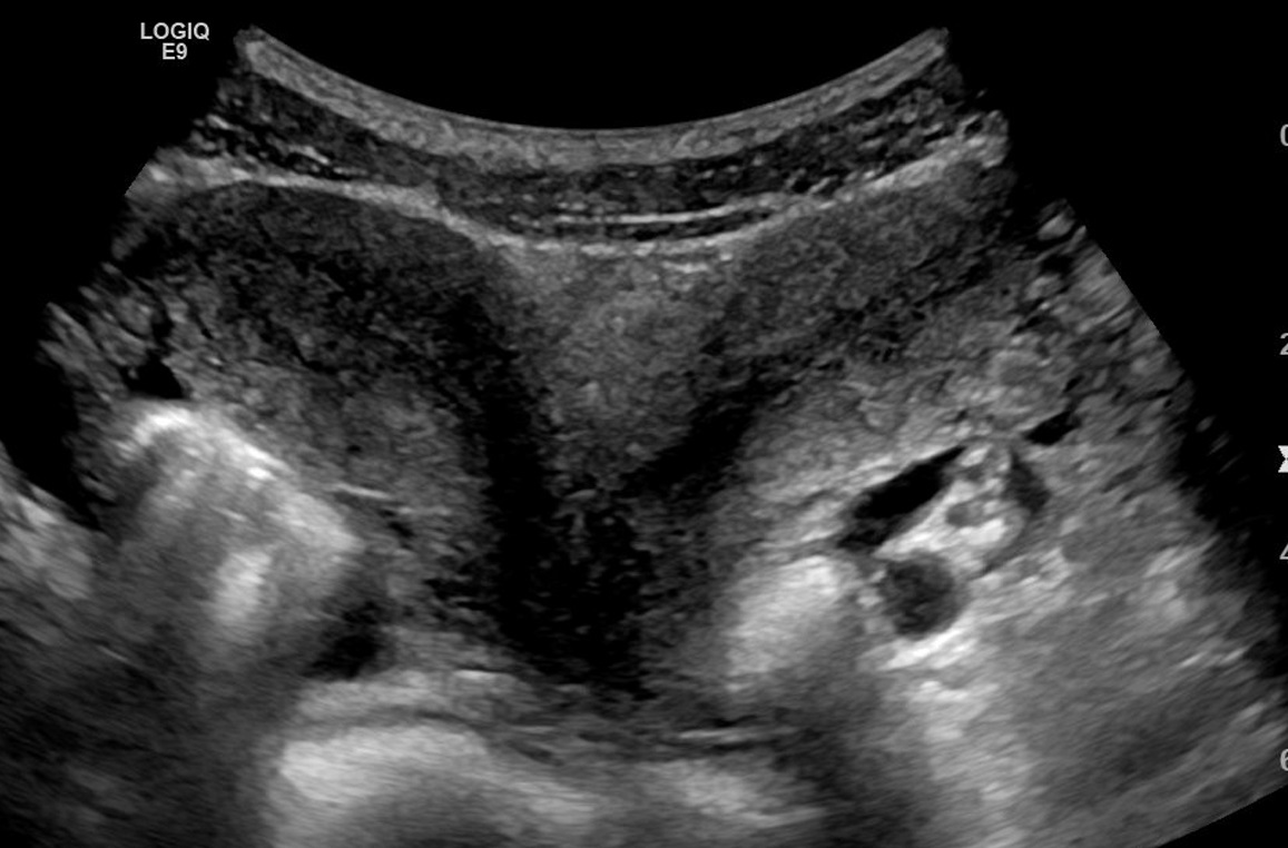 Tywkiwdbi Tai Wiki Widbee New Word Of The Day Uterine Didelphys