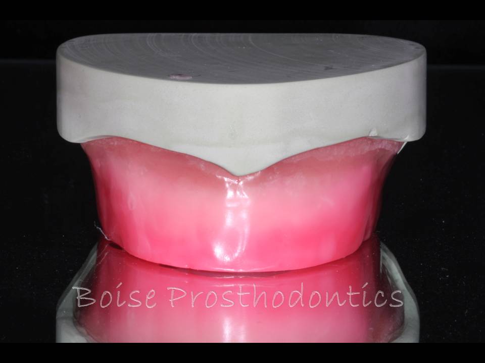 Boise Idaho Prosthodontics: Picture Sequence of Maxillary Complete ...