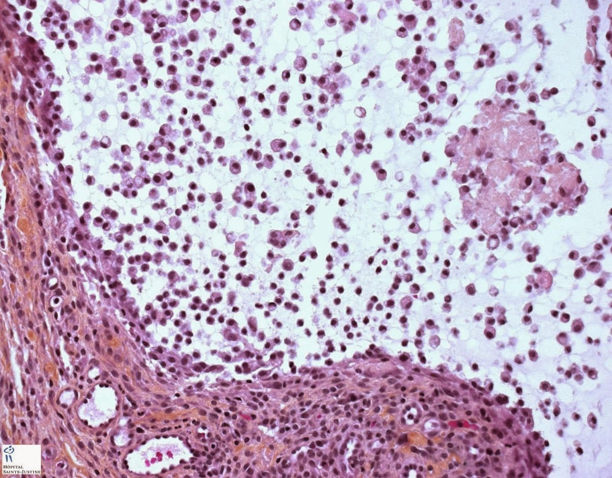 Mucocele, Rânula e Sialolitíase | Estomatologia Online