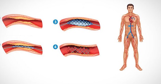 Heart Bypass Surgery: What Is Coronary Angioplasty And Stenting?