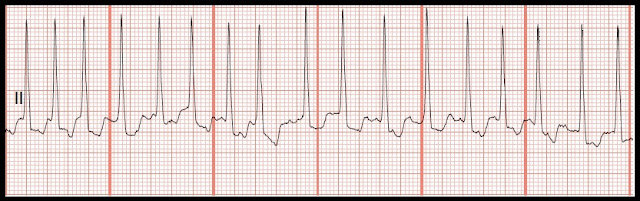 Practice EKG Rhythm Strips 158