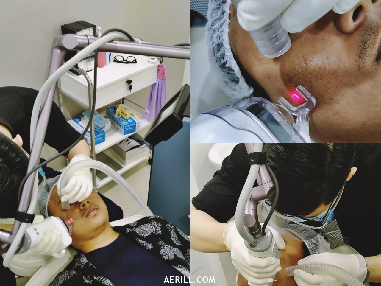 Pengalaman Buat Rawatan Fractional CO2 Laser di Dr Chong Clinic Kepong