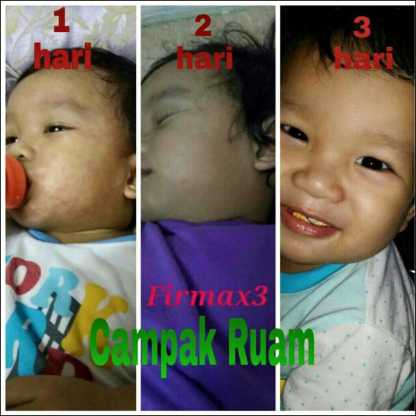 Firmax3 Magical Touch: Testimoni Firmax3 - Firmax3 sesuai untuk Ruam ...