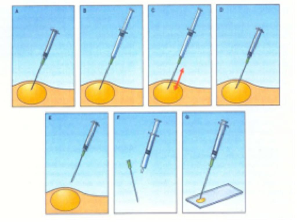 Pemeriksaan FNAB Pada Tumor
