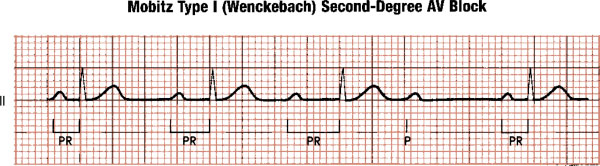 Second Degree Atrioventricular Block ECG Mobitz Type I Type II second-degree-atrioventricular-block-ecg-mobitz-type-i-type-ii