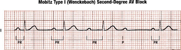 Second degree atrioventricular block - ECG / Mobitz type I, type II ...