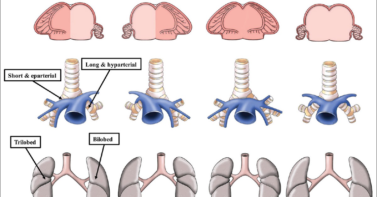 HealthforHeart: Transposition of the great arteries: A laterality ...