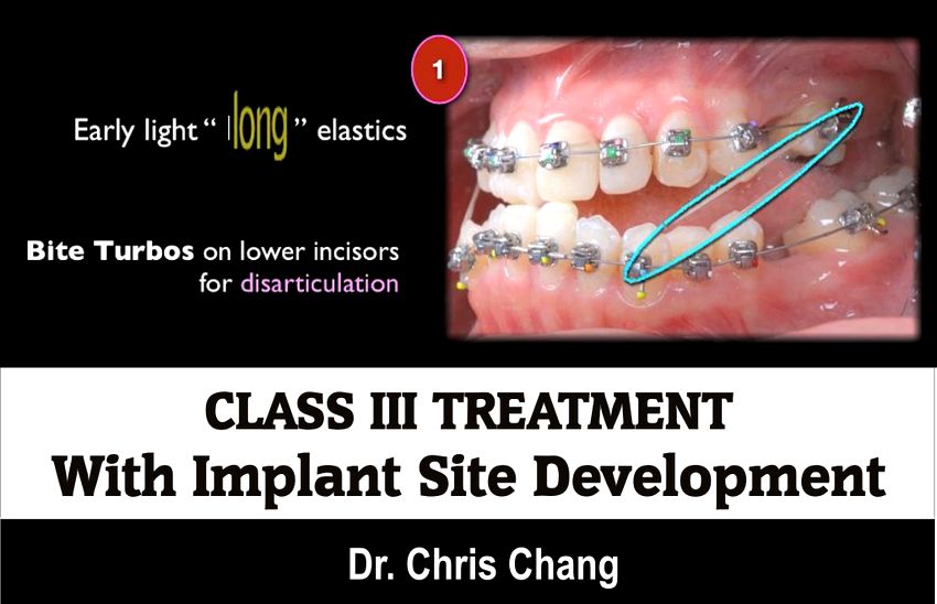 CLASS III TREATMENT with Implant Site Development - Dr. Chris Chang