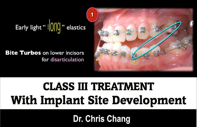CLASS III TREATMENT with Implant Site Development - Dr. Chris Chang