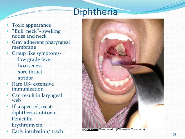 Plab King Grey Membrane On Tonsil 4791700
