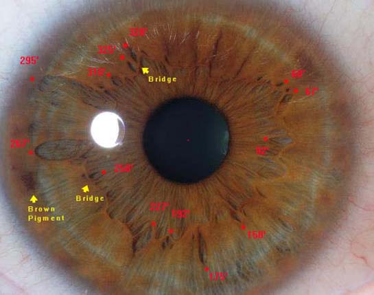 Modern & Multidimensional Iridology: Iris Signs at Internal & External ...