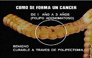 TU SENTIR MUJER TUS LUCHAS CONTRA EL CANCER: Lesión en la matriz