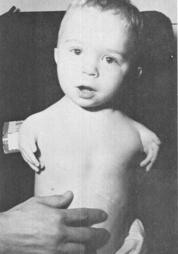 GEDR: SÍNDROME focomelia Schinzel