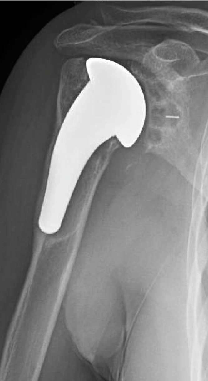 UW Shoulder and Elbow Academy: Short stemmed humeral implants - what we ...