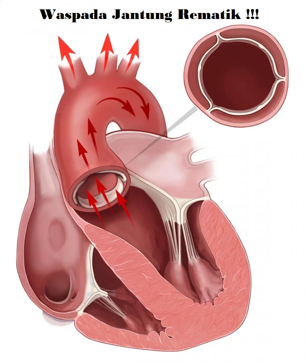 Penyakit Jantung Rematik Pdf - Perumperindo.co.id