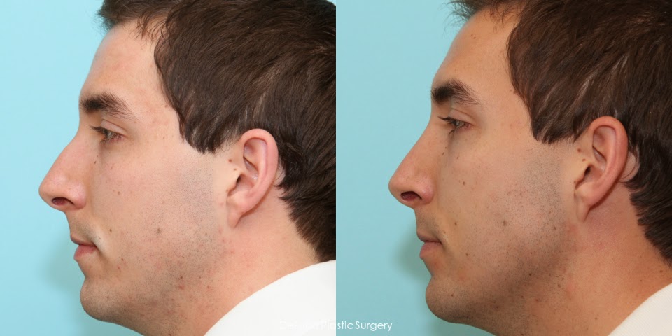 Medical Treatment Pictures-for Better Understanding: Septoplasty ...