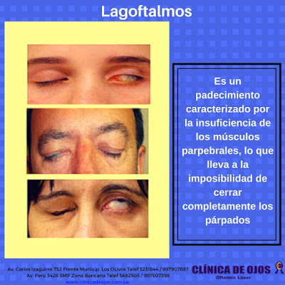 Clínica de Ojos Oftalmic Láser: LAGOFTALMOS