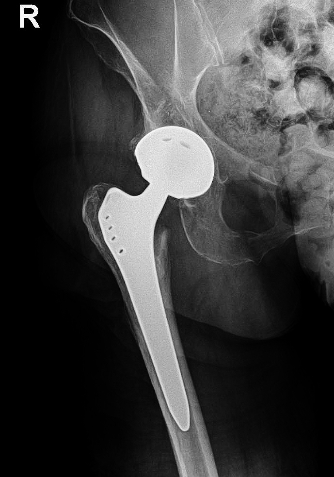 Interesting Topics in Orthopedic Surgery by Dr. Nasar: How are Hip ...