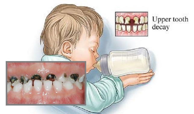 Biarkan Anak Tidur Sambil Hisap Botol Susu Punca Utama Gigi Rosak ...