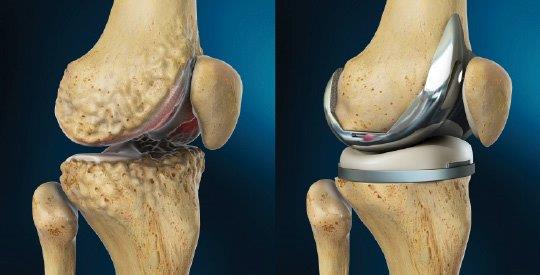 LDH Blog: My experience with knee replacement surgery