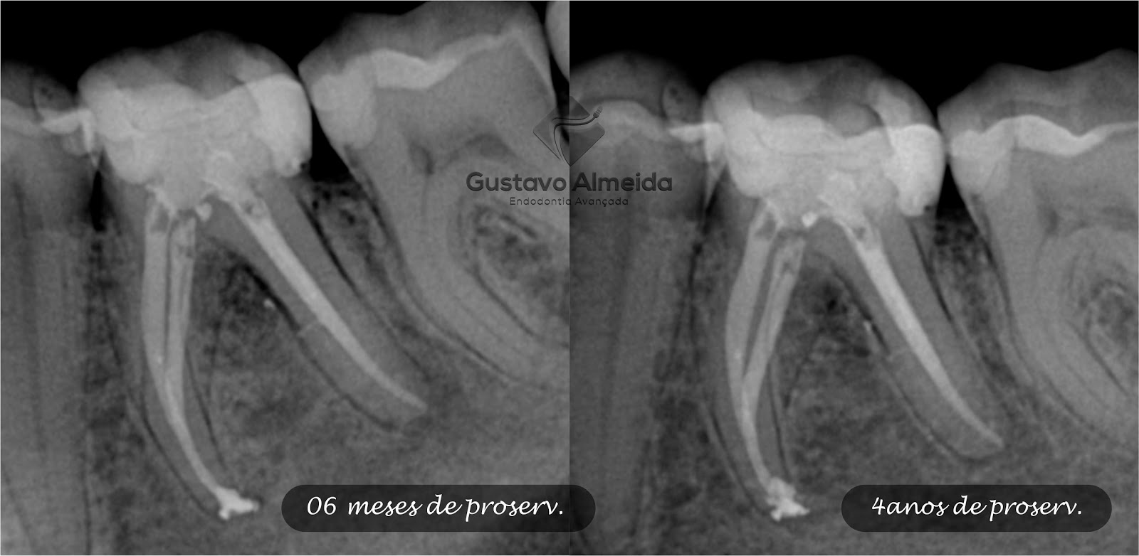 PERIODONTITE APICAL – LESÃO DE FURCA (CASO DO DIA) | Endo Gustavo Almeida