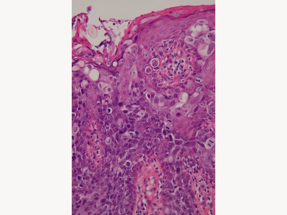 Dermpath Made Simple - Neoplastic: Other Malignant Epidermal Tumours