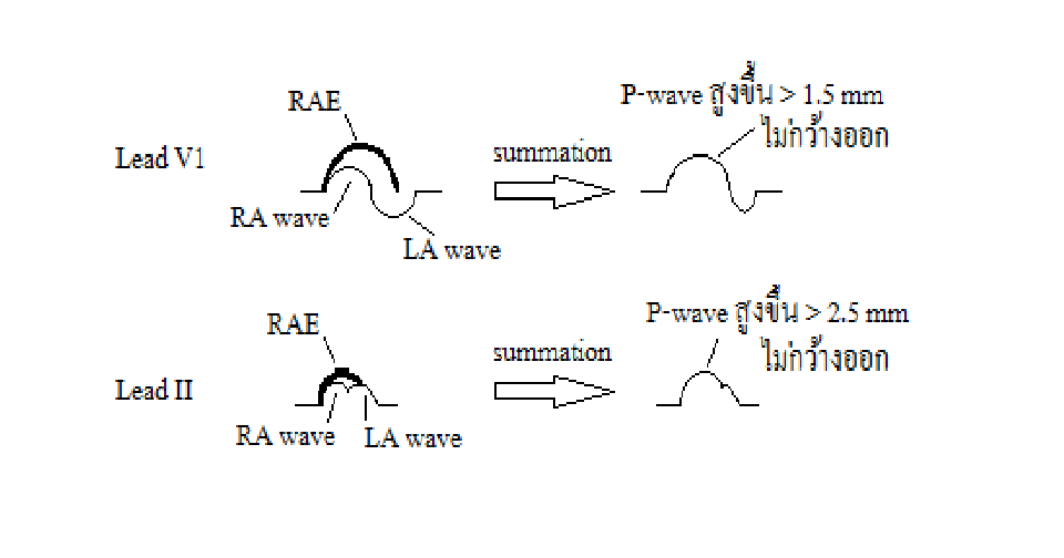 อัพเดตความรู้วันนี้: การอ่าน right atrial enlargement (RAE) มีหลักการ ...