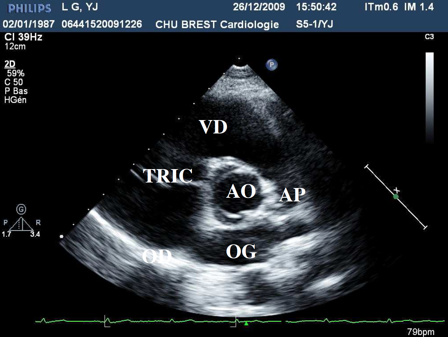 WEBANESTH: L'ETT pour les Nuls en réanimation