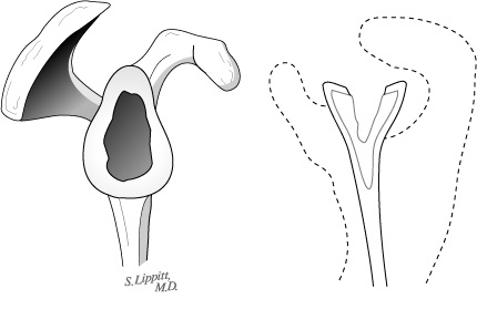 UW Shoulder and Elbow Academy: Revision surgery for failed shoulder ...