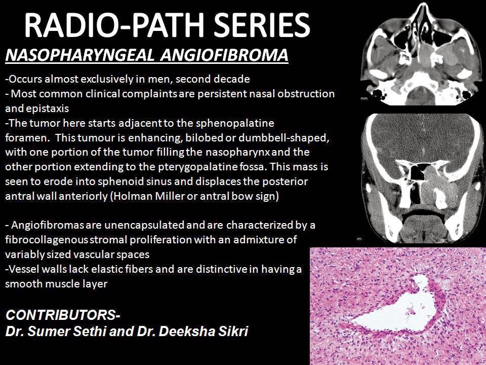 Angiofibroma-Radiopath Series - Sumer's Radiology Blog