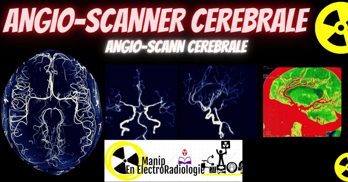 ANGIOSCANNER CEREBRALE