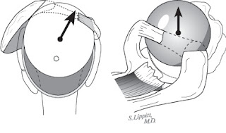 UW Shoulder and Elbow Academy: Revision surgery for failed shoulder ...