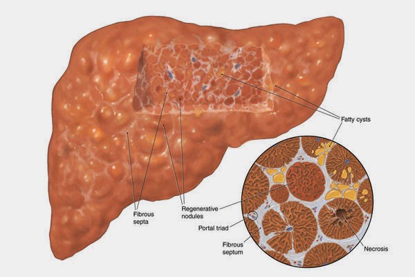 ASKEP SIROSIS HEPATIS - MUZARRO