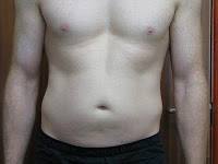 Selston Cosmetic Clinic: Achieve Six-Pack Abs With Vaser Hi-Def ...