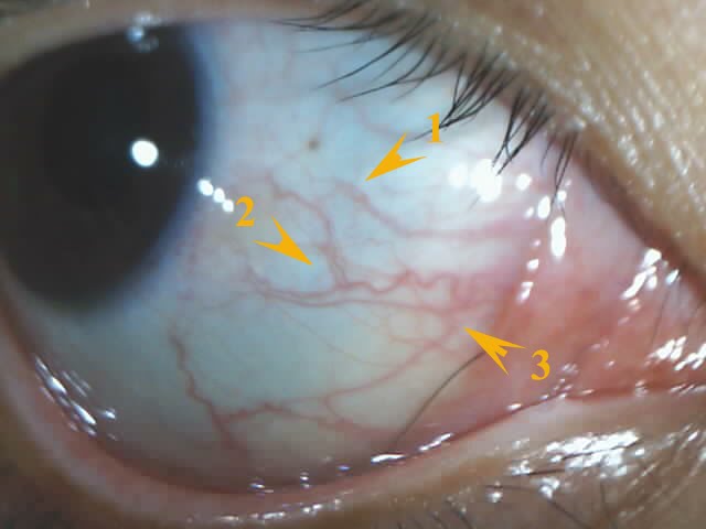 Modern & Multidimensional Iridology: Structural & Stress Signs in Iris ...