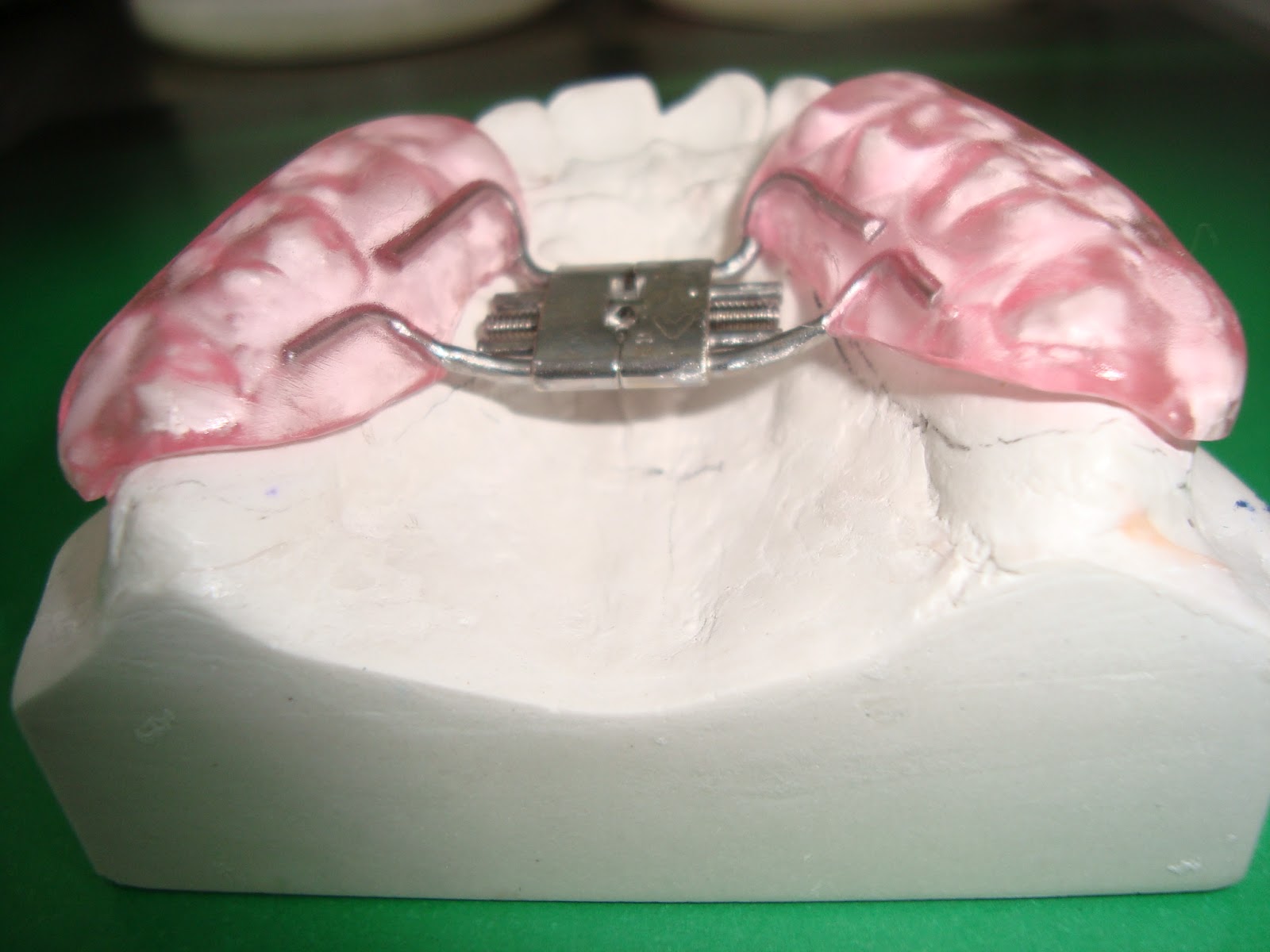 Laboratório Ortodôntico Bohrer: APARELHO DE MACNAMARA COM EXP.HIRAX