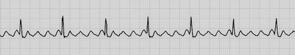 MedicEd makes it simple: Fast Rhythms_The Tachycardias