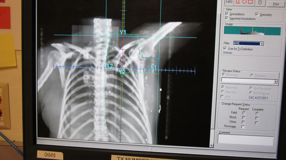 Chemo Transit: Radiation Therapy finally starts