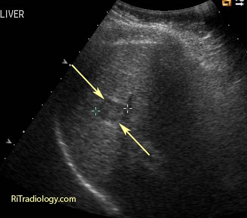 RiT radiology: AFP-Negative Hepatocellular Carcinoma