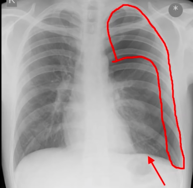 EM Didactic: Deep Sulcus Sign - Pneumothorax