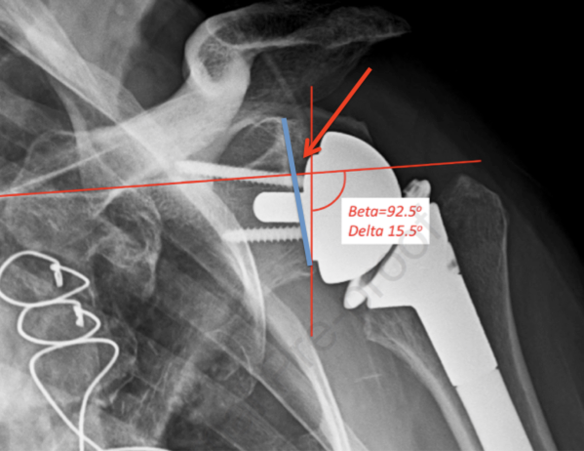 Shoulder Arthritis / Rotator Cuff Tears: causes of shoulder pain ...