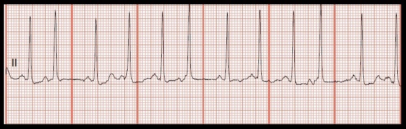 Practice EKG Strips 363