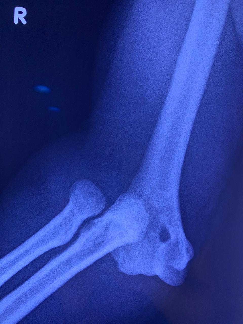 Revisiones_bibliográficas TyO_Web: Luxación de codo