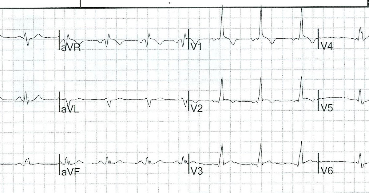 Dr. Smith's ECG Blog: Chest Pain and Right Bundle Branch Block. What is ...