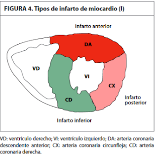 Cardiopatia Isquemica : INFARTO AGUDO DE MIOCARDIO