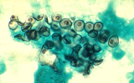 Pneumocystis jiroveci