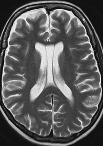Cavum Septum Pellucidum-Mayo Radiology